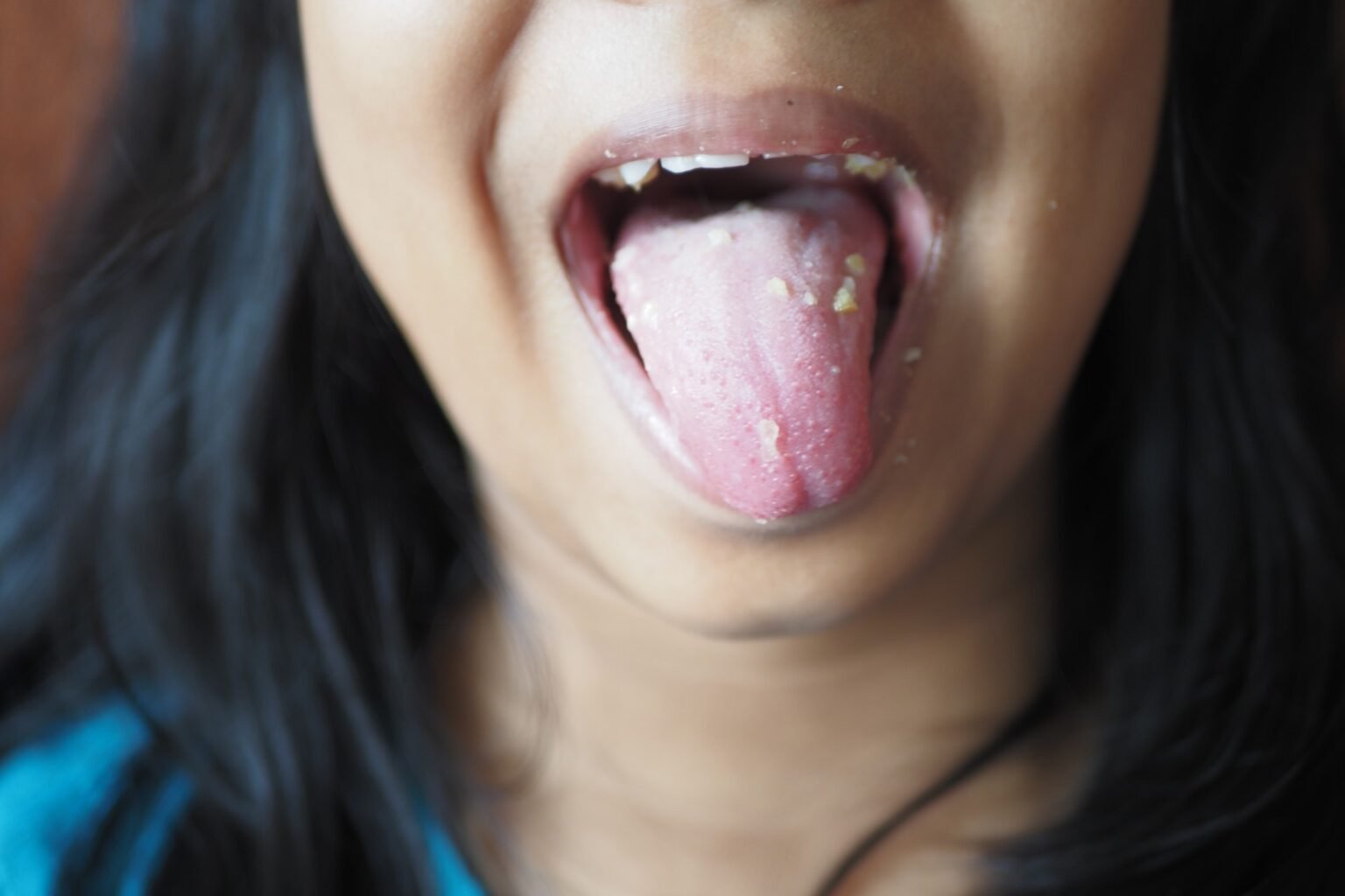 Learning More About a Fissured Tongue, Its Causes, and Possible ...